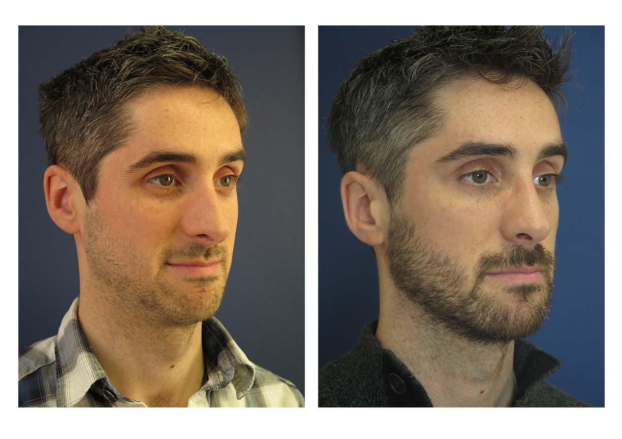 NYC Rhinoplasty (Nose Surgery) Before and After Pictures | Upper East Side