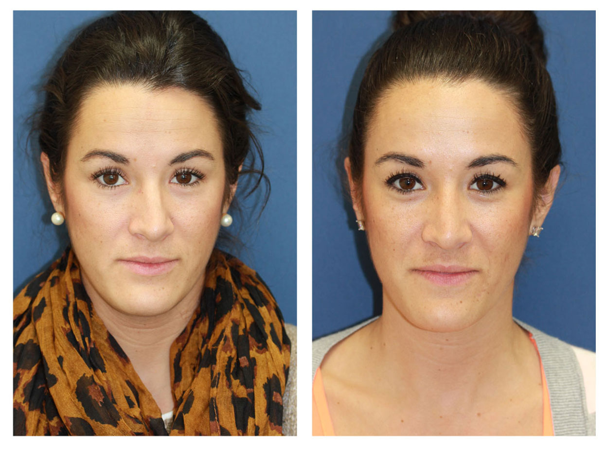 NYC Rhinoplasty (Nose Surgery) Before and After Pictures | Upper East Side