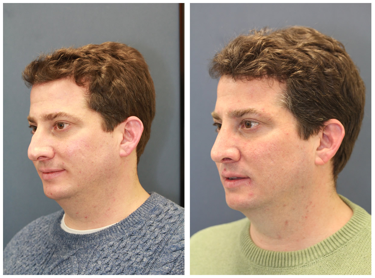 NYC Rhinoplasty (Nose Surgery) Before and After Pictures | Upper East Side