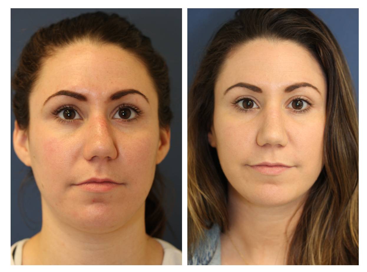 NYC Rhinoplasty (Nose Surgery) Before and After Pictures | Upper East Side